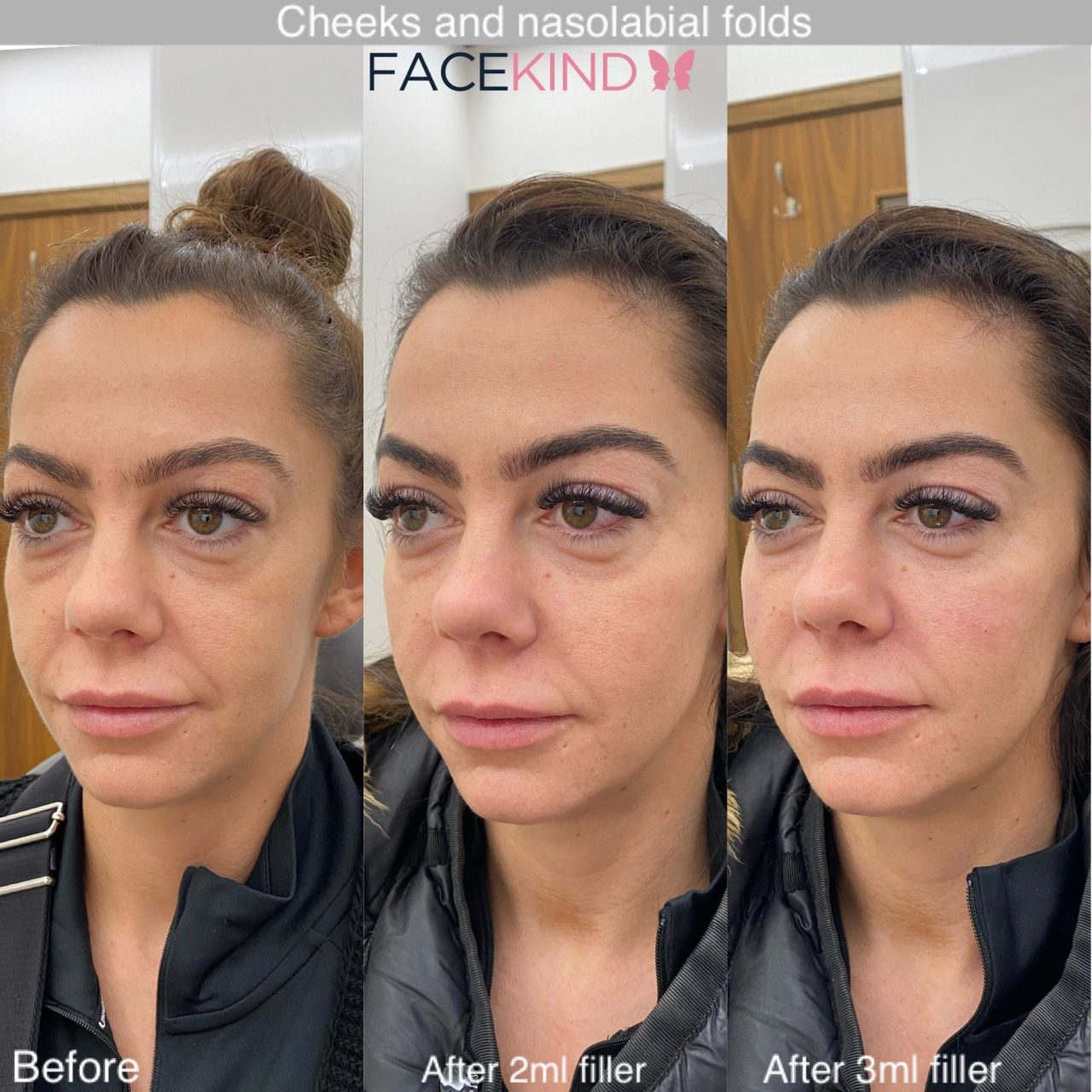 Before And After - DentalKind