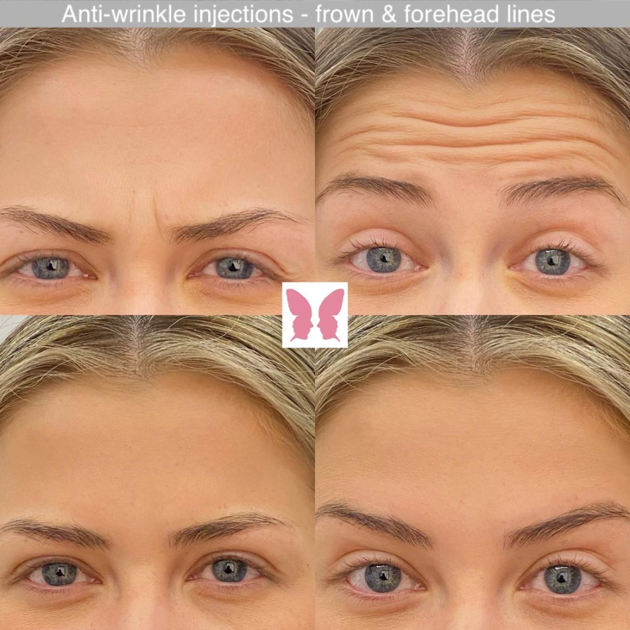 Anti-Wrinkle Injections Treatment By FaceKind In Billericay Essex