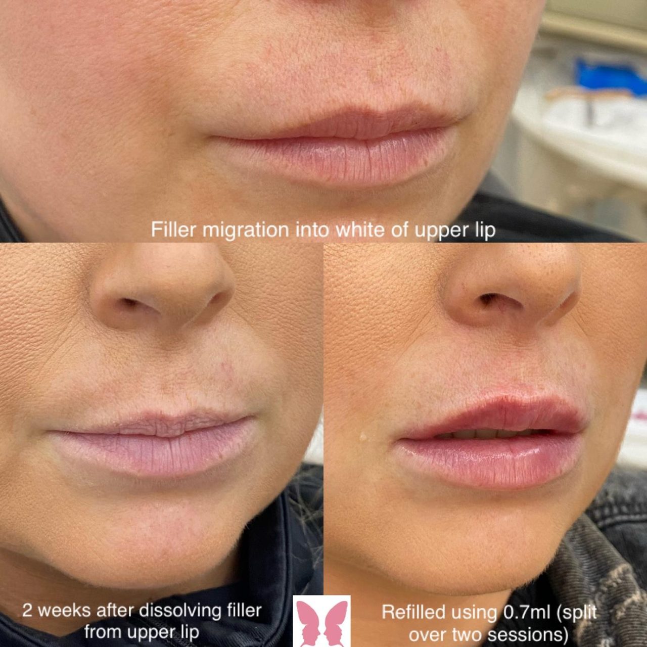 Filler Dissolving - DentalKind
